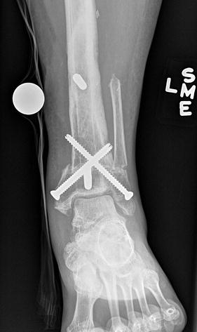 Supramalleolar Dome Osteotomy for Malunion of the Tibia | SpringerLink