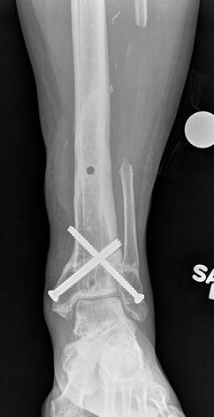 Supramalleolar Dome Osteotomy for Malunion of the Tibia | SpringerLink