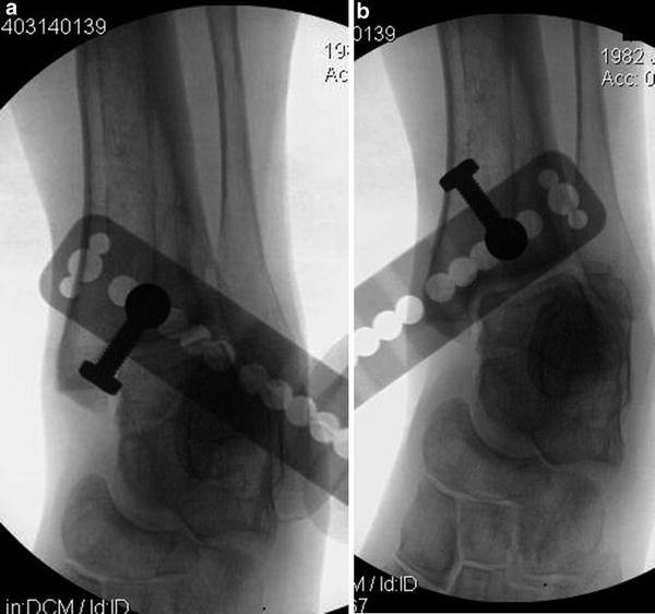 Supramalleolar Dome Osteotomy for Malunion of the Tibia | SpringerLink