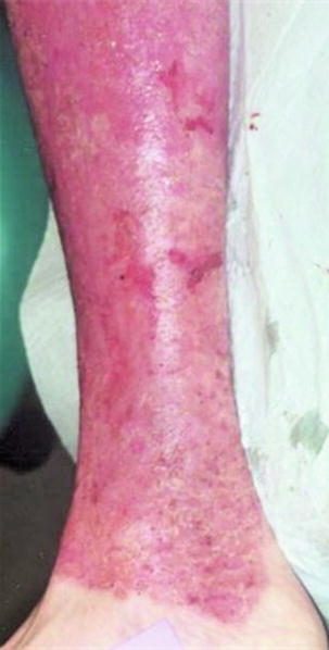 Scleroderma and Sclerodermoid Skin Conditions | SpringerLink