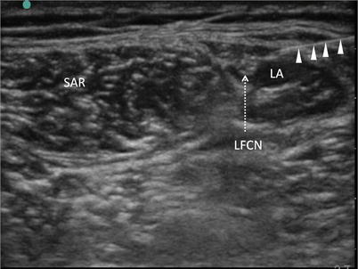 Lateral Femoral Cutaneous Nerve Block | SpringerLink