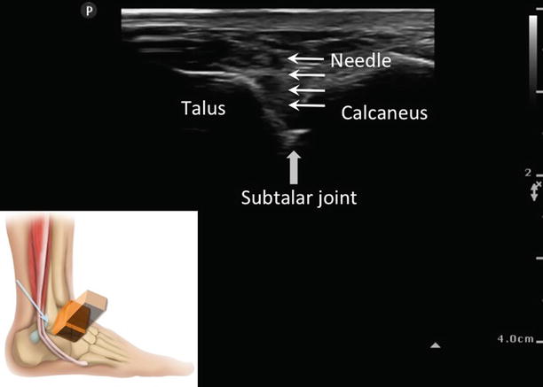 Talotibial (Talocrural) and Subtalar Intra-articular Injection ...