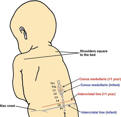 Pediatric Nerve Blockade: Trunk and Neuraxial | SpringerLink