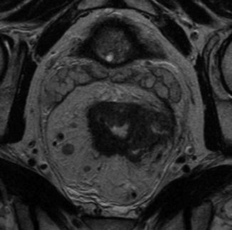 Surgical Anatomy of the Rectum and the TME Specimen (Total Mesorectal ...