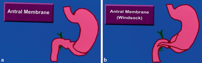Congenital Gastric Outlet Obstruction (Pyloric and Antral Atresia and ...