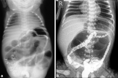Neonatal Intestinal Obstruction | SpringerLink