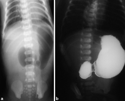 Neonatal Intestinal Obstruction | SpringerLink