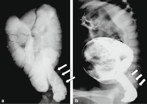 Hirschprung’s Disease (Congenital Aganglionic Megacolon) | SpringerLink