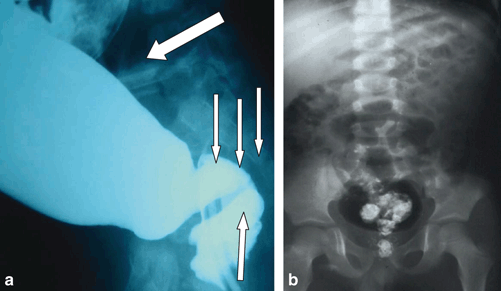 Hirschprung’s Disease (Congenital Aganglionic Megacolon) | SpringerLink