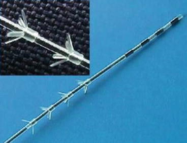 Sacral Nerve Modulation for Fecal Incontinence | SpringerLink