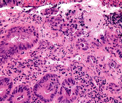 Drug-Induced Colitis | SpringerLink