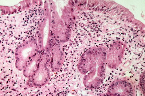 Drug-Induced Colitis | SpringerLink