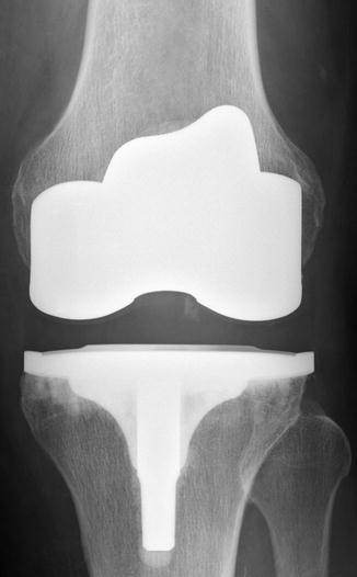 15 The Problem of Under-or Oversizing of Total Knee Replacement ...