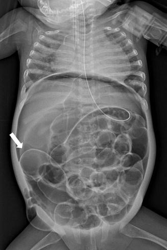 Imaging of Gastrointestinal Tract Perforation in the Pediatric Patient ...