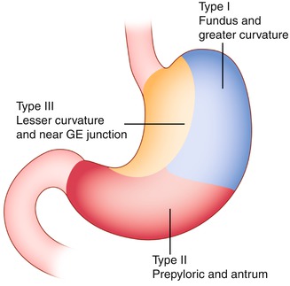 Laparoscopic Partial Gastrectomy | SpringerLink