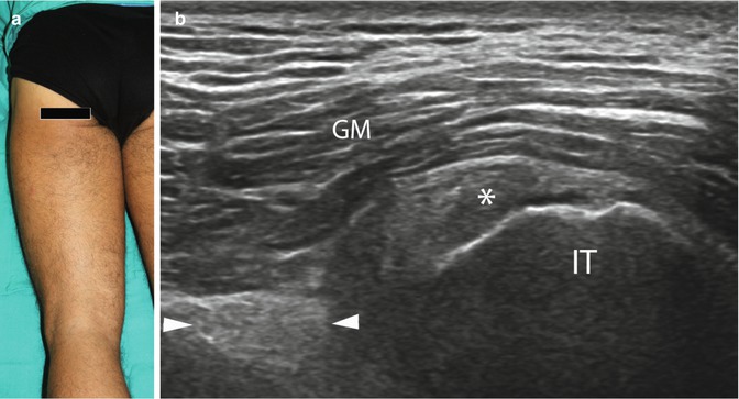 Hamstrings | SpringerLink