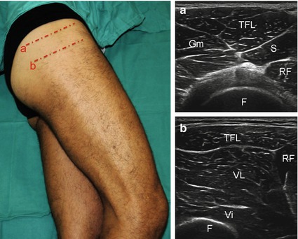 Sartorius and Tensor Fasciae Latae | SpringerLink