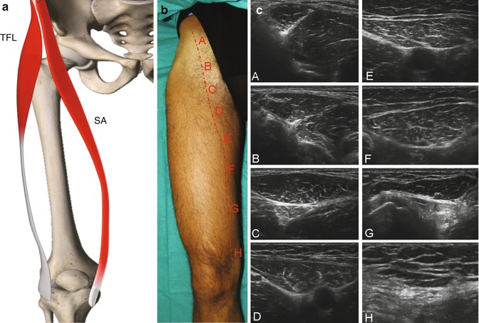 Sartorius and Tensor Fasciae Latae | SpringerLink