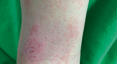 Skin Disorders | SpringerLink