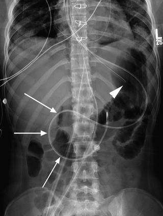 Abdominal Hardware and Tubes | SpringerLink