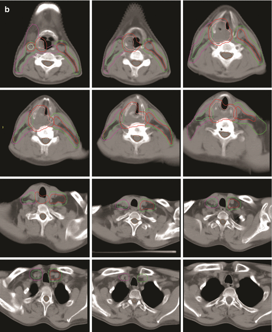 Hypopharyngeal Cancer | SpringerLink