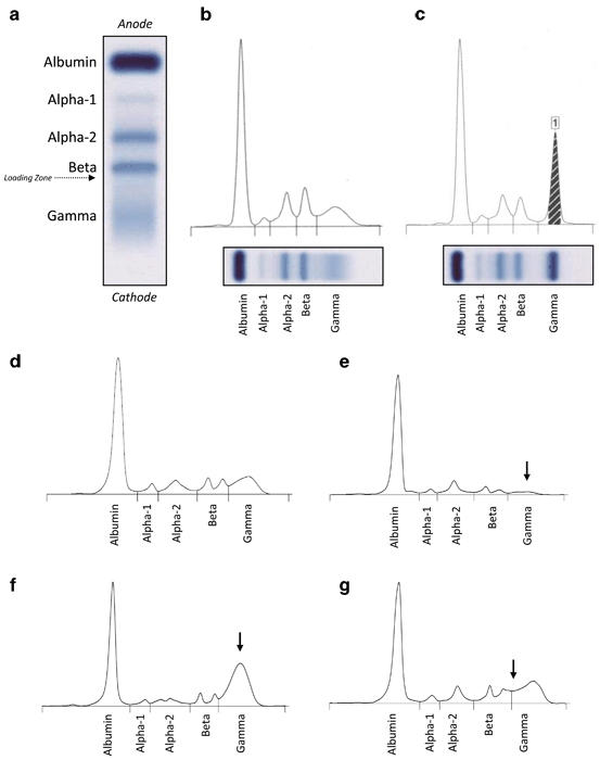 Clinical Protein and Immunofixation Electrophoresis | SpringerLink