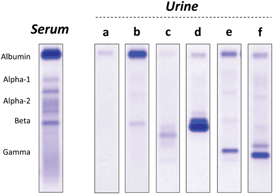 Clinical Protein and Immunofixation Electrophoresis | SpringerLink