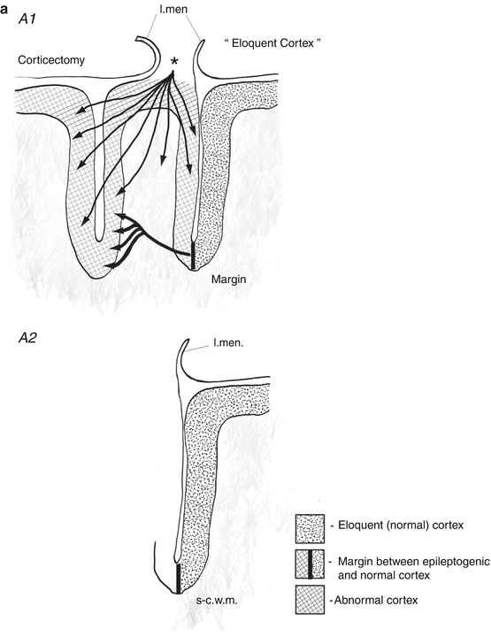 Corticectomy | SpringerLink