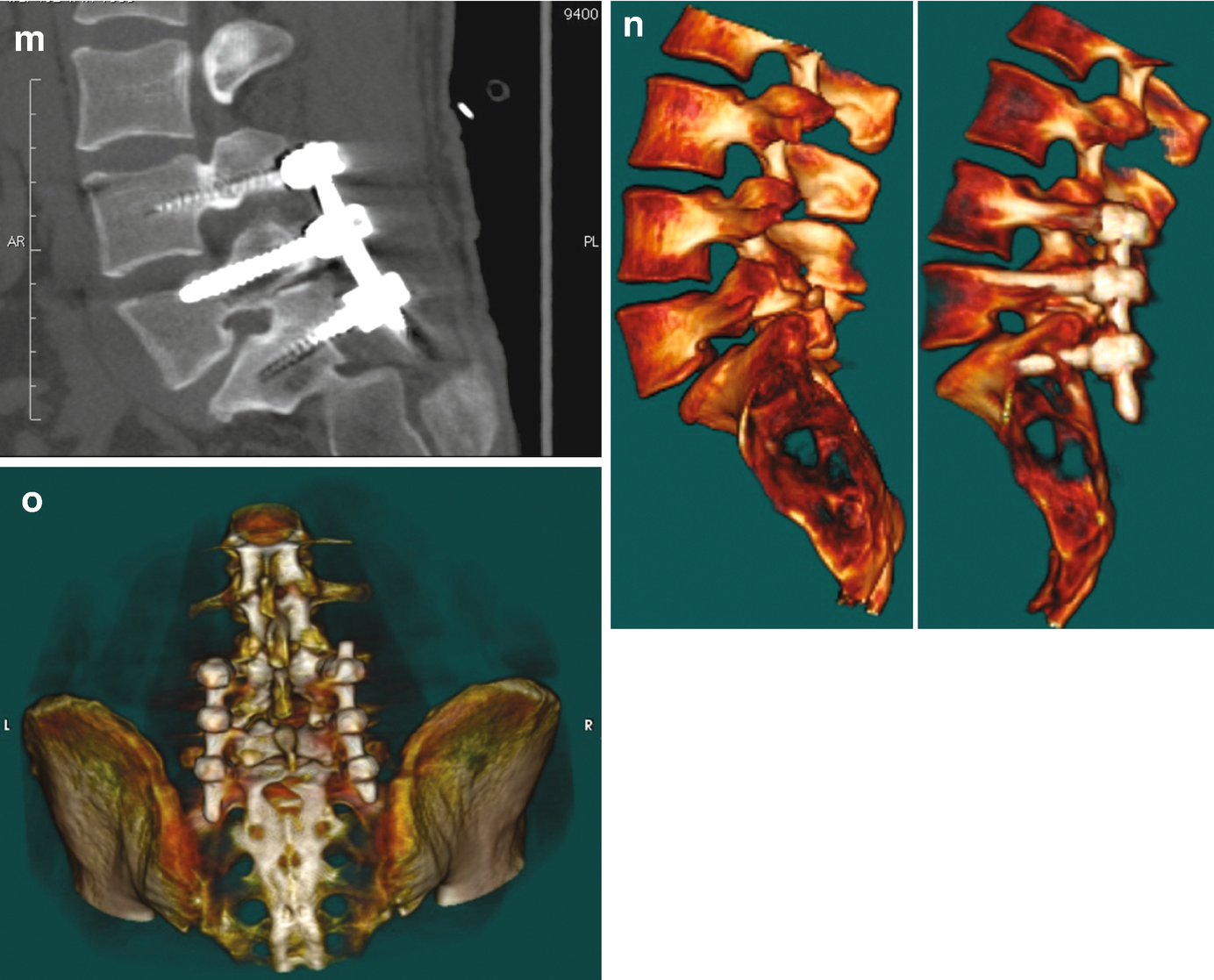 CT-/X-Ray-Guided Technique in Posterior Lumbar Spine Fusion | SpringerLink