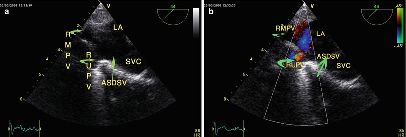 Atrial Septal Defect (Sinus Venosus Type) with a Partial Anomalous ...