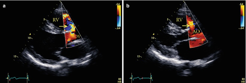 Residual Ventricular Septal Defect Post Surgery (Patch Closure ...
