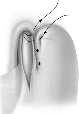 Laparoscopic Heller Myotomy and Dor Fundoplication | SpringerLink