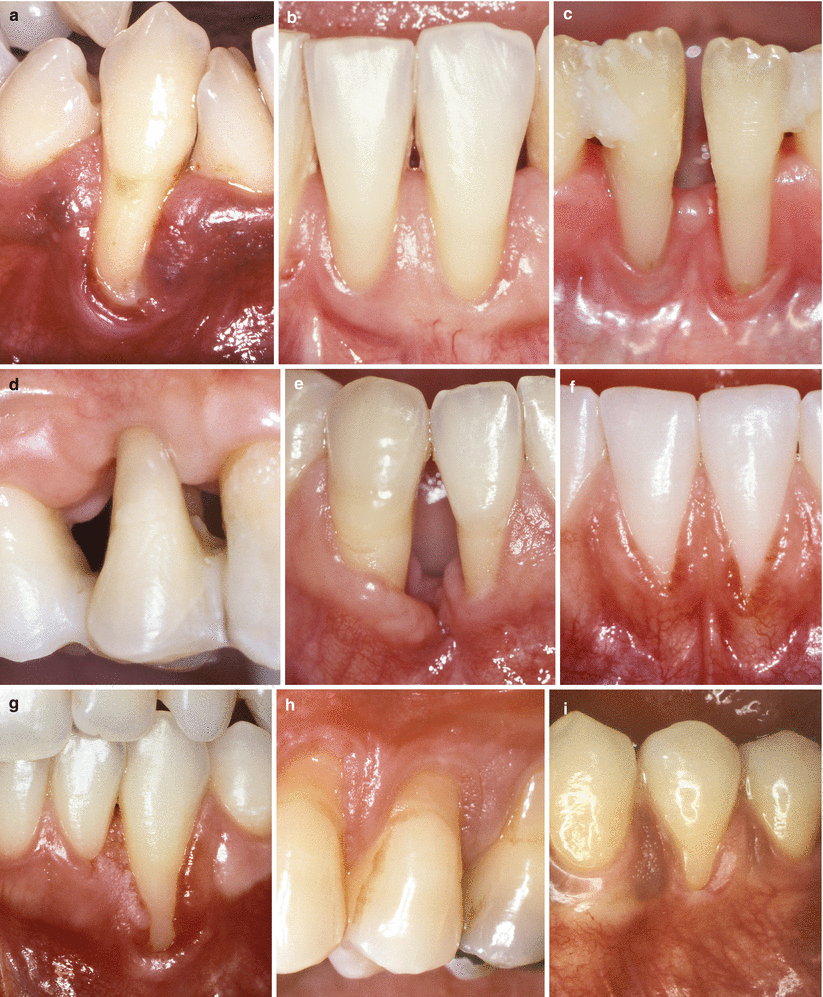 Rationale for the Surgical Treatment of Single and Multiple Recession ...