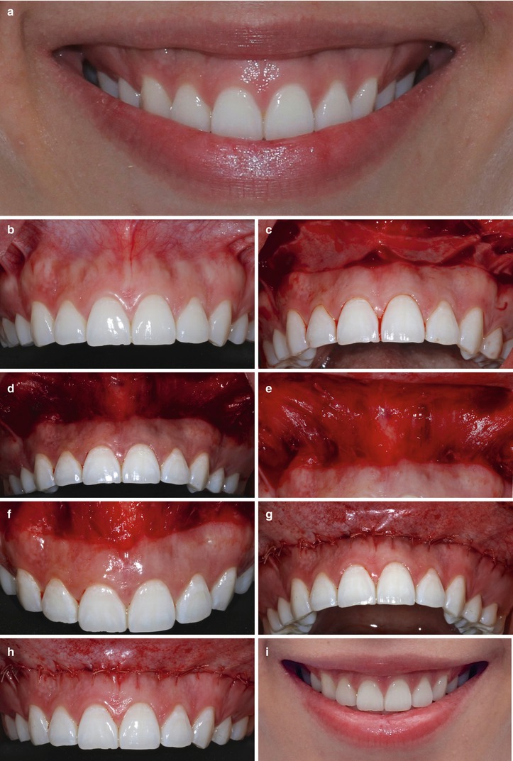 Esthetical Clinical Crown Lengthening, Lip Repositioning, and Gingival ...