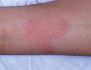 Special Aspects of Familial Mediterranean Fever in Childhood | SpringerLink