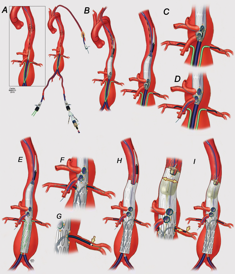 Techniques of Implantation of Fenestrated and Multibranched Stent ...