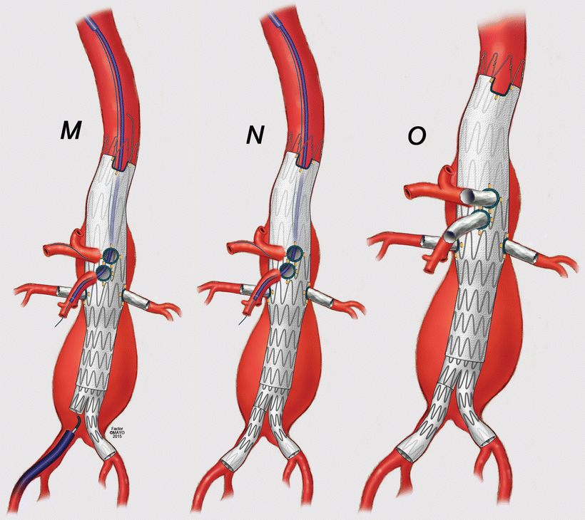 Techniques of Implantation of Fenestrated and Multibranched Stent ...