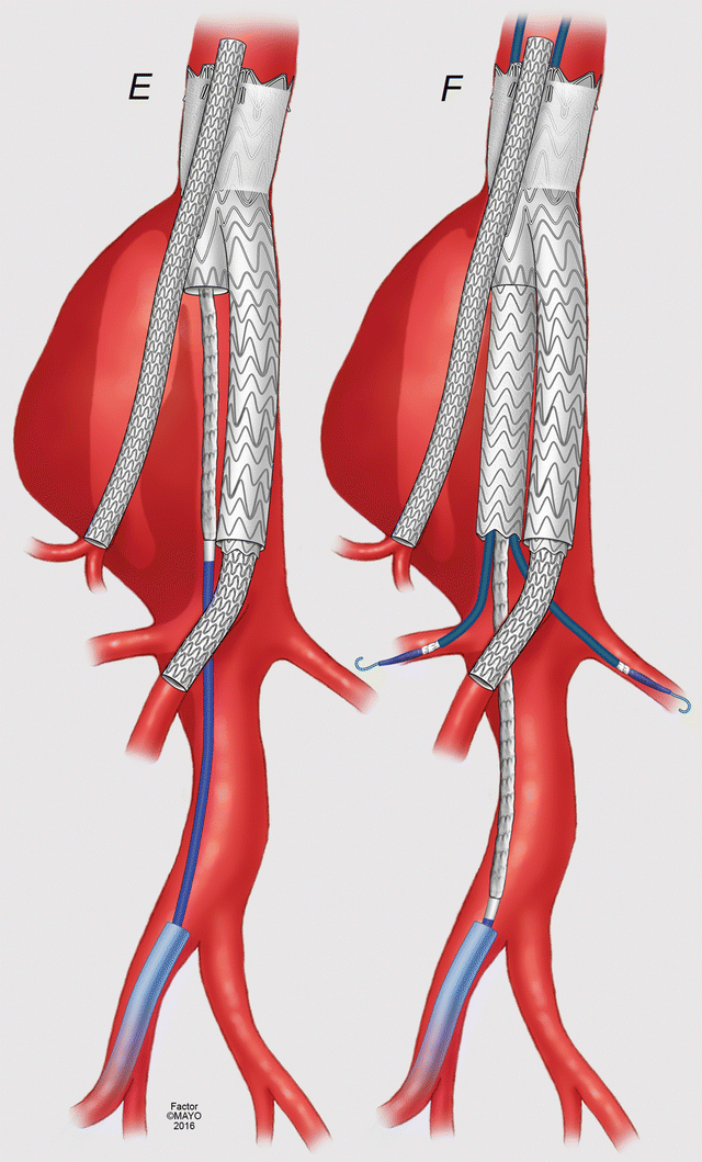 Parallel Graft Techniques to Treat Complex Aortic Aneurysms Involving ...