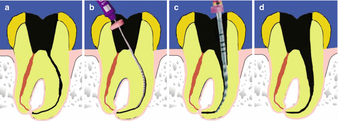 Endodontic Armamentarium | SpringerLink