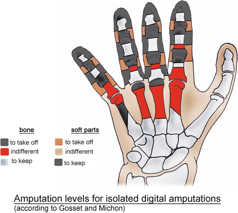 Amputations | SpringerLink