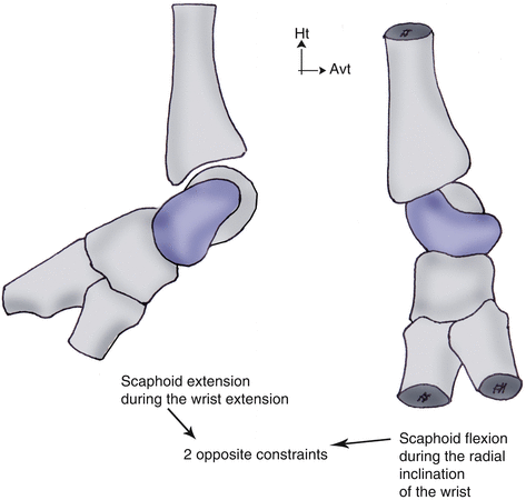 Sprains of the Scapholunate Ligament | SpringerLink
