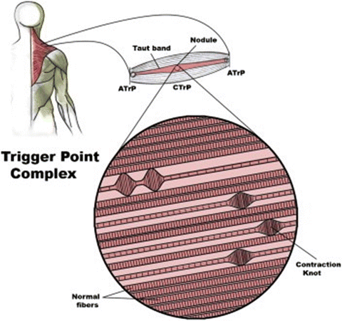 Trigger Point Injections for the Treatment of Pain in the ...