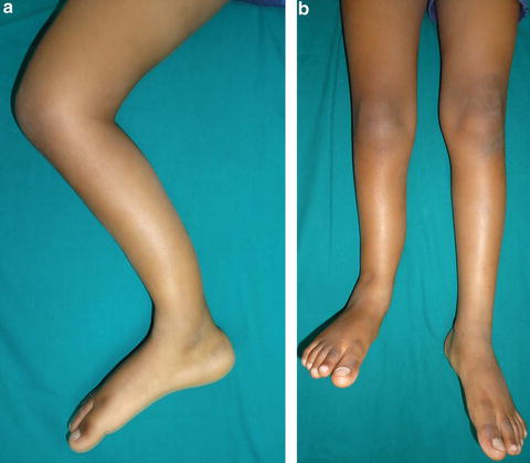 Etiology of Lower Limb Deformity | SpringerLink