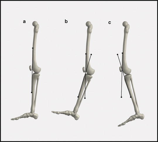 Pediatric Joint Contractures | SpringerLink