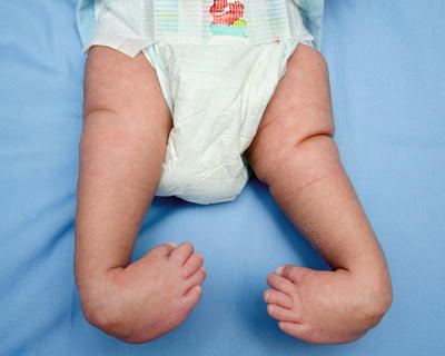 Arthrogryposis | SpringerLink