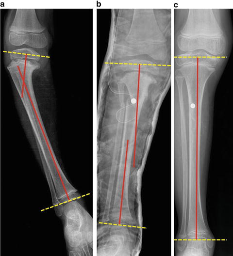 Acute Deformity Correction Using an Osteotomy | SpringerLink