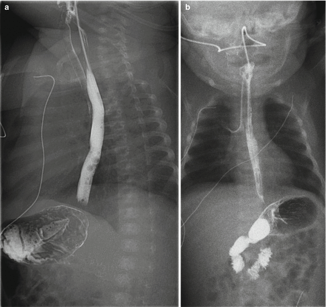 The Esophagus | SpringerLink