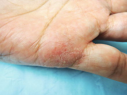 Pompholyx | SpringerLink