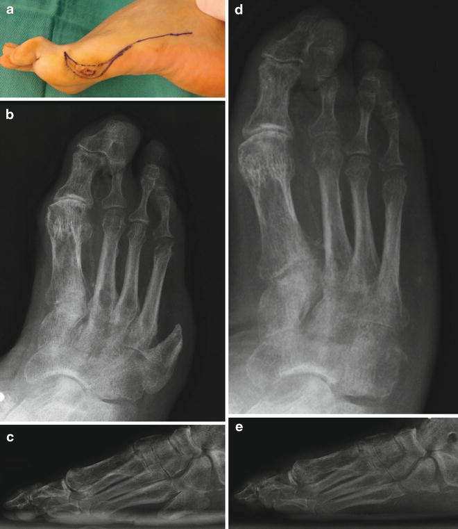 Fifth Ray Osteomyelitis | SpringerLink