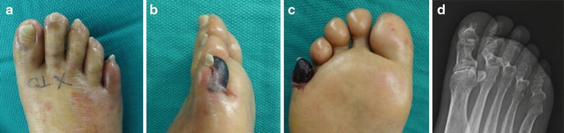 Fifth Ray Osteomyelitis | SpringerLink
